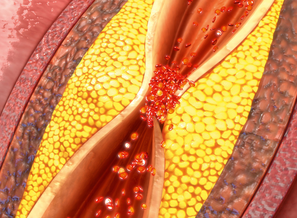 small dense LDL (sdLDL) - Neuheiten und Innovationen - Analysen | labor ...