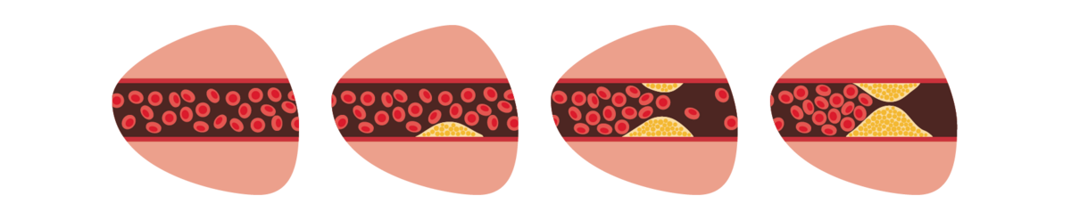 small dense LDL (sdLDL) - Neuheiten und Innovationen - Analysen | labor ...