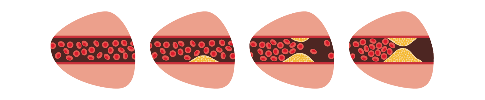 small dense LDL (sdLDL) - Neuheiten und Innovationen - Analysen | labor ...